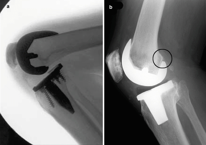 23 Impingement After Total Knee Replacement | SpringerLink