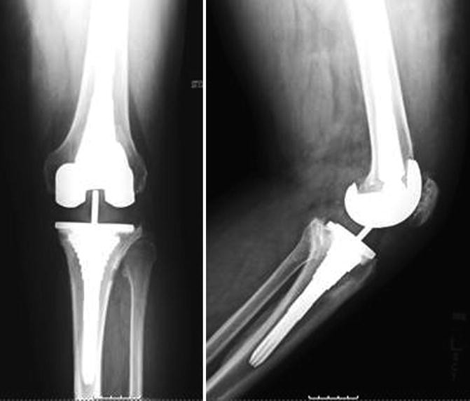 47 Cementless Versus Cemented Revision Total Knee Replacement ...