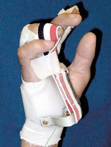 Splints: Mobilization, Corrective Splintage, and Pressure Therapy for ...