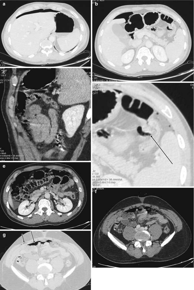 Small Bowel Perforations: Imaging Findings | SpringerLink