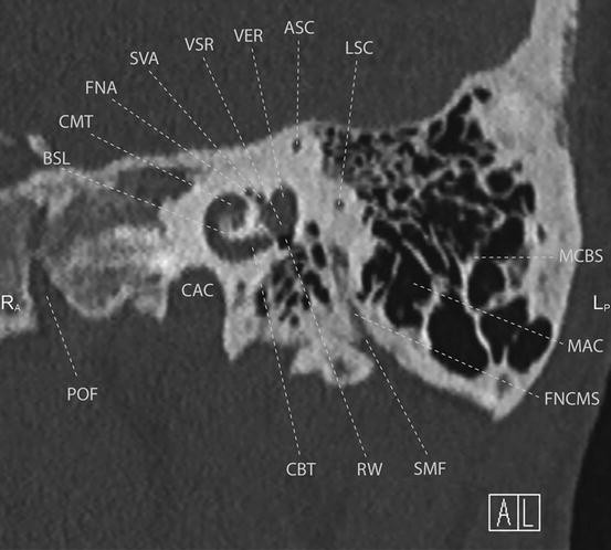 HRCT Stenvers Reformat | SpringerLink