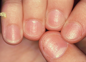 Differential Diagnosis for Nail Psoriasis | SpringerLink