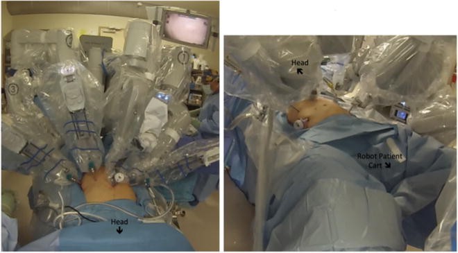 Robotic-Assisted Total Abdominal Colectomy | SpringerLink