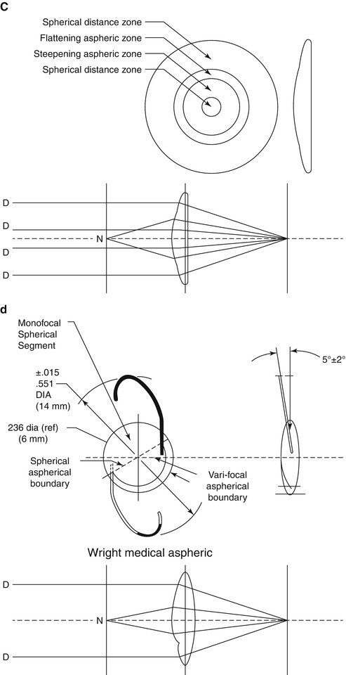 Multifocal Intraocular Lenses: Historical Perspective | SpringerLink