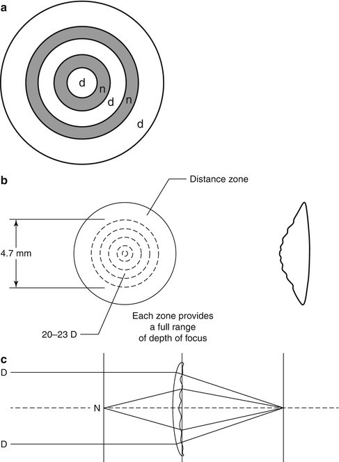 Multifocal Intraocular Lenses: Historical Perspective | SpringerLink