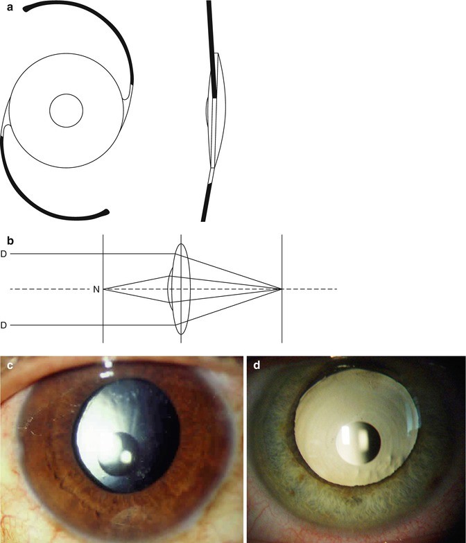 Multifocal Intraocular Lenses: Historical Perspective | SpringerLink