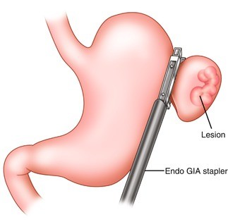 Laparoscopic Partial Gastrectomy | SpringerLink
