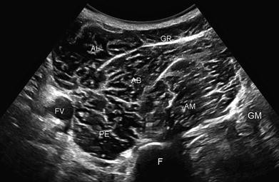 Adductors, Gracilis, and Pectineus | SpringerLink