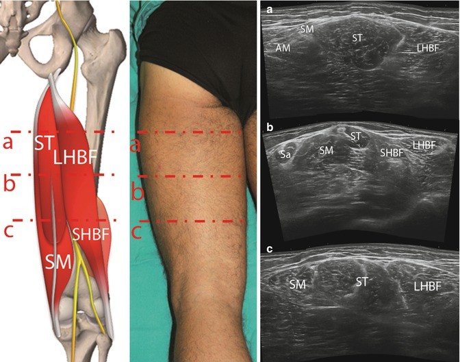 Hamstrings | SpringerLink