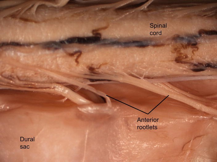 Spinal Dural Sac, Nerve Root Cuffs, Rootlets, and Nerve Roots ...