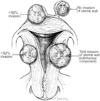 Pathophysiology of Uterine Myomas and Its Clinical Implications ...