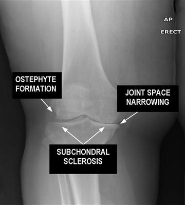 Arthritides | SpringerLink