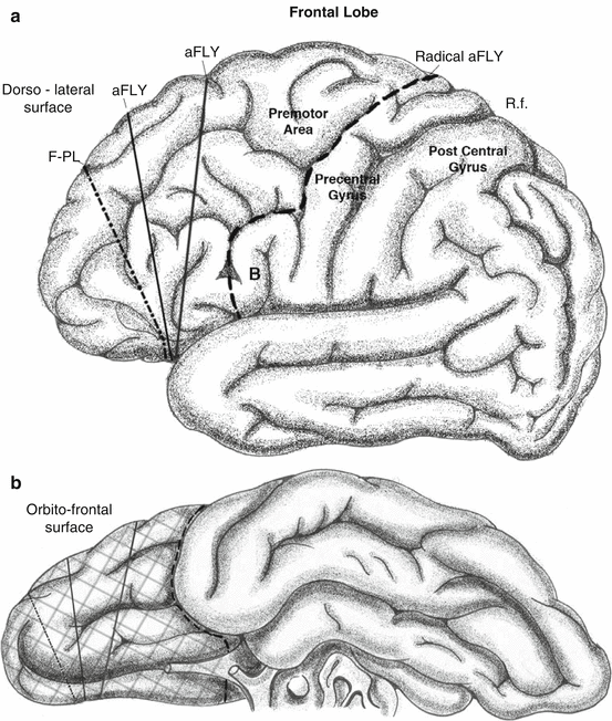 Frontal Lobe Surgery | SpringerLink