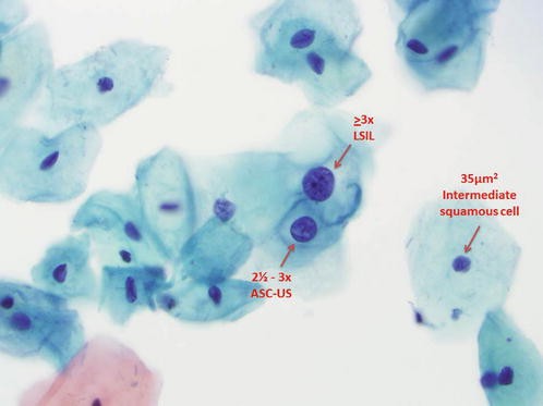 Epithelial Cell Abnormalities: Squamous | SpringerLink