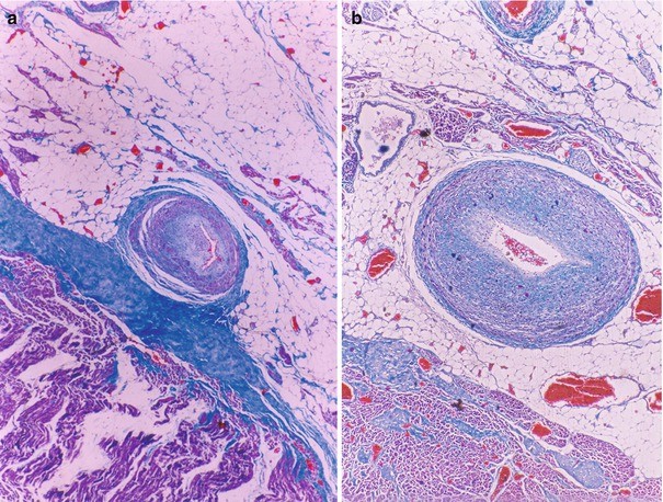 Pathology of the Cardiac Conduction System | SpringerLink