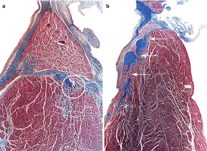 Pathology of the Cardiac Conduction System | SpringerLink