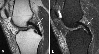MRI of PCL, Posteromedial, and Posterolateral Corner Injuries of the ...