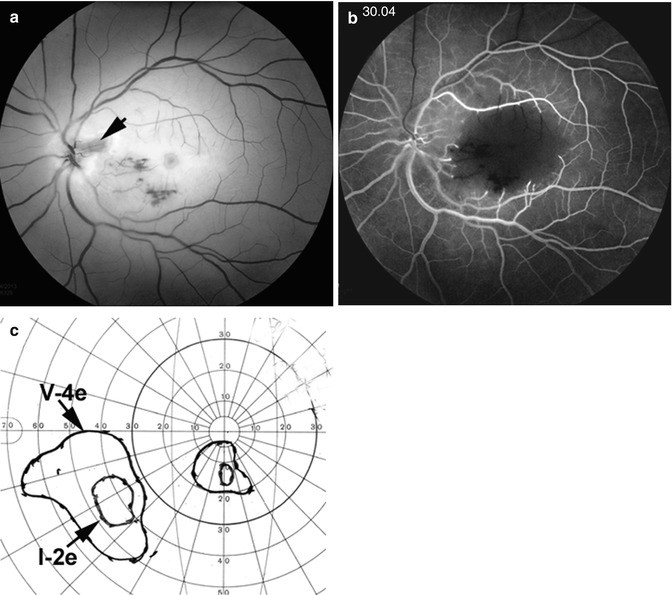 Central Retinal Artery Occlusion | SpringerLink