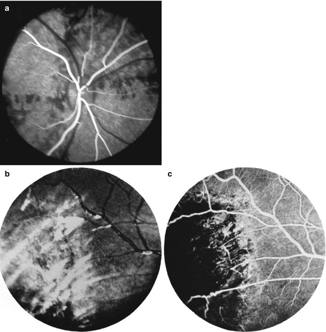 Vortex Vein Occlusion | SpringerLink