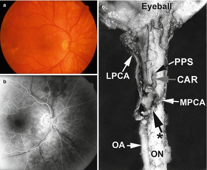 Amaurosis Fugax in Ocular Vascular Occlusive Disorders | SpringerLink