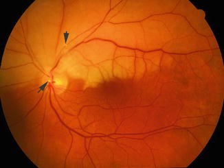 Amaurosis Fugax in Ocular Vascular Occlusive Disorders | SpringerLink