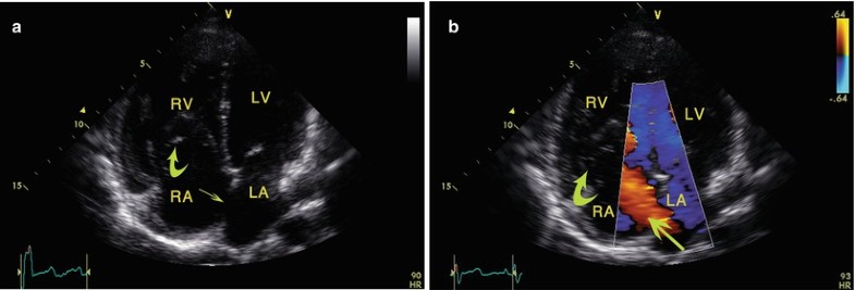 Atrial Septal Defect (Ostium Secundum Type) with a Prominent Chiari ...