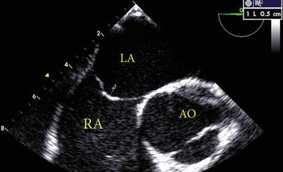 Fenestrated Interatrail Septum “Swiss Cheese-like Atrial Septal Defect ...