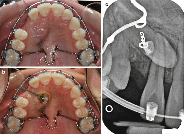 Failure of Tooth Eruption: Diagnosis and Management | SpringerLink