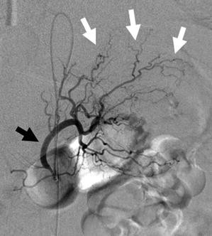 Left Gastric Artery Embolization to Treat Obesity: Rationale, Technique ...
