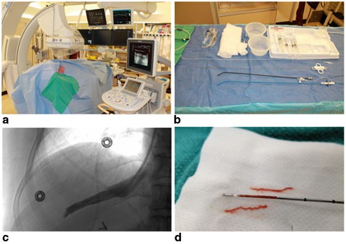 Measurement of Portal Pressure and Transjugular Liver Biopsy | SpringerLink