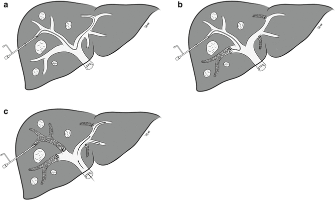 Portal Vein Embolization | SpringerLink