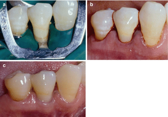 Noncarious Cervical Lesions: Prevalence, Etiology, and Management ...