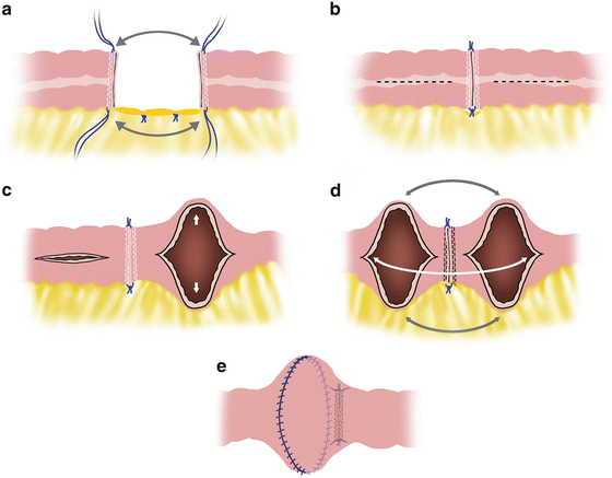 Surgery: Small Intestine Terminal Ileum—Resection | SpringerLink