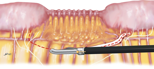 Recurrent CD: Surgical Prophylaxis—Kono-S Anastomosis | SpringerLink
