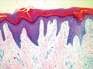 What Is Psoriasiform Dermatitis? | SpringerLink