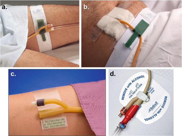 Indwelling (Transurethral and Suprapubic) Catheters | SpringerLink