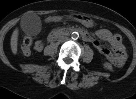 The Use of Imaging in Gallbladder Disease | SpringerLink