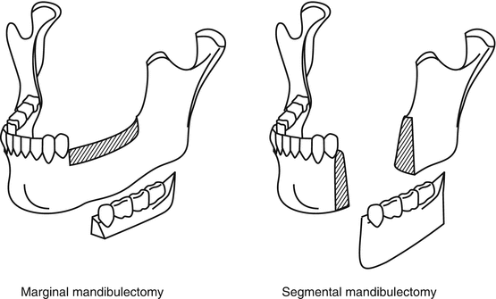 Surgical Management of Oral Squamous Cell Carcinoma | SpringerLink
