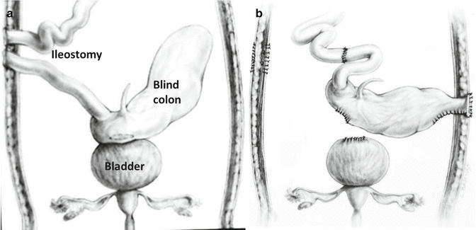 Cloacal Exstrophy and Covered Cloacal Exstrophy | SpringerLink