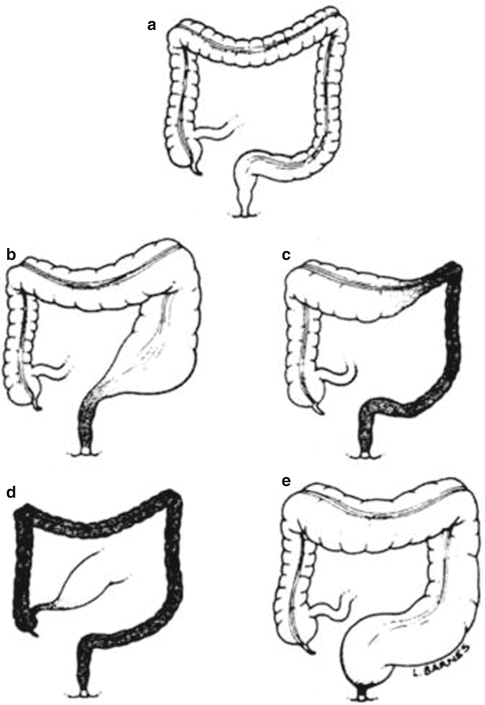 Hirschsprung’s Disease | SpringerLink
