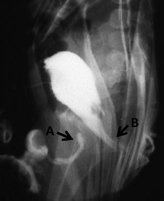 Recto-perineal Fistula | SpringerLink