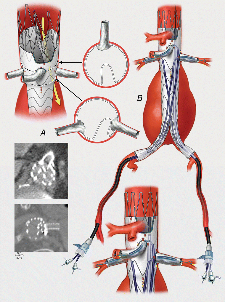 Principles of Side Branch Incorporation and “Bail Out” Maneuvers ...