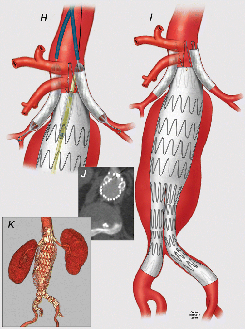 Parallel Graft Techniques to Treat Complex Aortic Aneurysms Involving ...