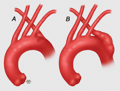 Normal Aortic Anatomy and Variations of Its Branches | SpringerLink