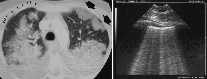 Lung Rockets: The Ultrasound Sign of Interstitial Syndrome | SpringerLink