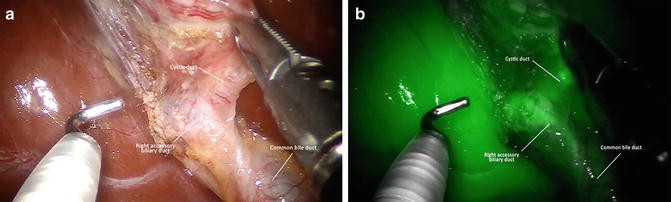Robotic Surgery Using Firefly System | SpringerLink