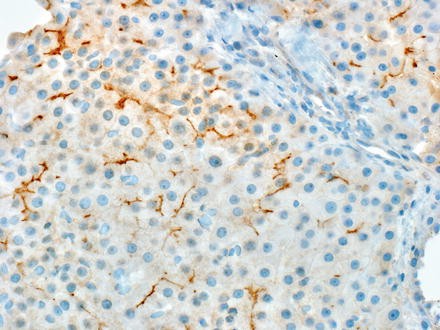 Hepatocellular Carcinoma | SpringerLink