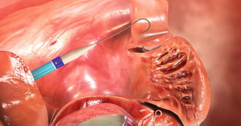 WATCHMAN Device | SpringerLink