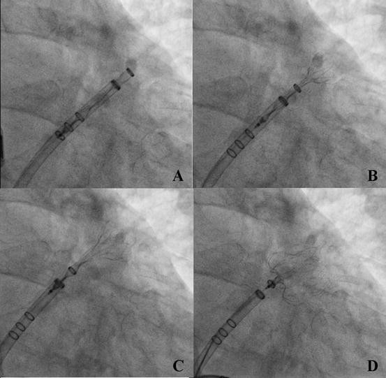 WATCHMAN Device | SpringerLink