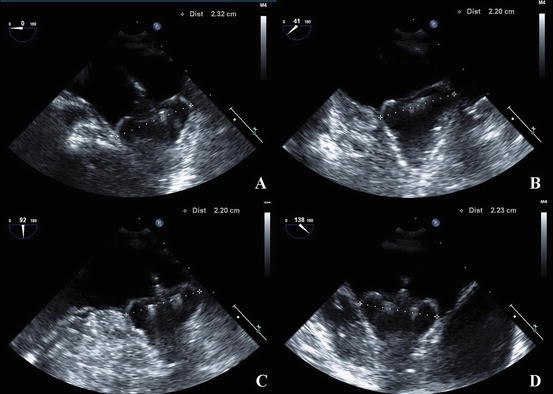 WATCHMAN Device | SpringerLink
